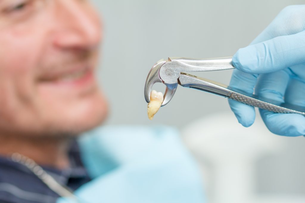 Tooth Extraction in Raleigh NC | Safe & Gentle Removal
